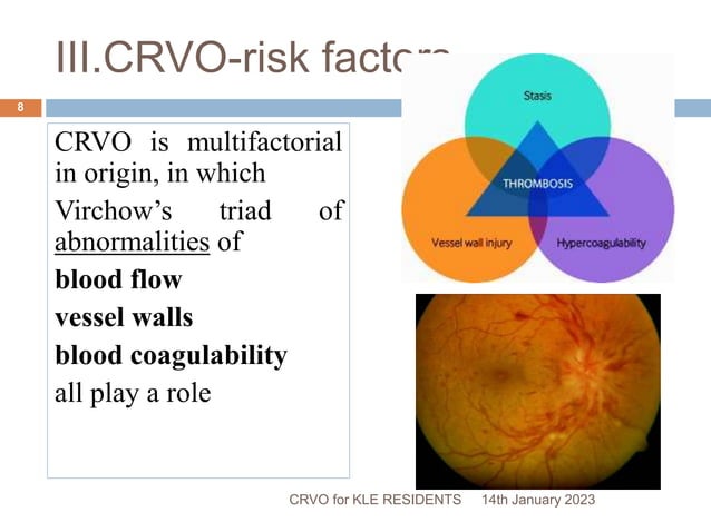 DR WANI'S TALK ON CRVO FOR RESIDENTS KLE 14 JAN 2023.pptx | Eye and ...