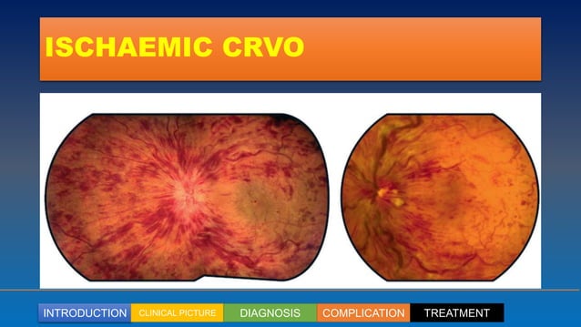 Crvo management 2019 doscon | PPTX | Eye and Vision Conditions ...