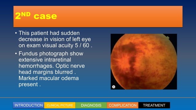 Crvo management 2019 doscon | PPTX | Eye and Vision Conditions ...