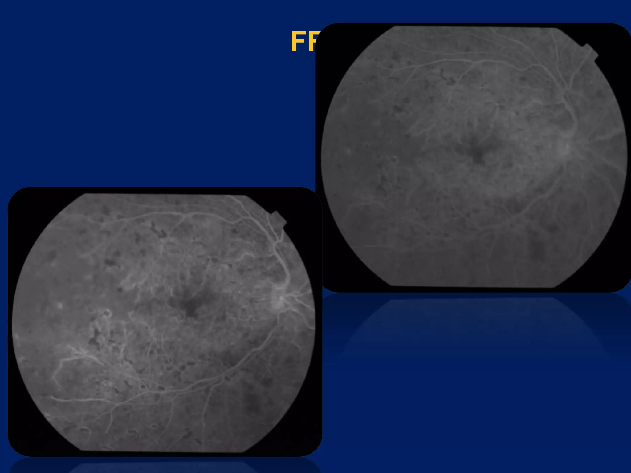 Crvo management -AJAY DUDANI | PPTX | Eye and Vision Conditions ...