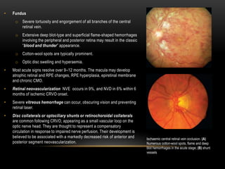 Crvo seminar final | PPTX
