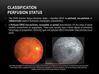 Crvo seminar final | PPTX