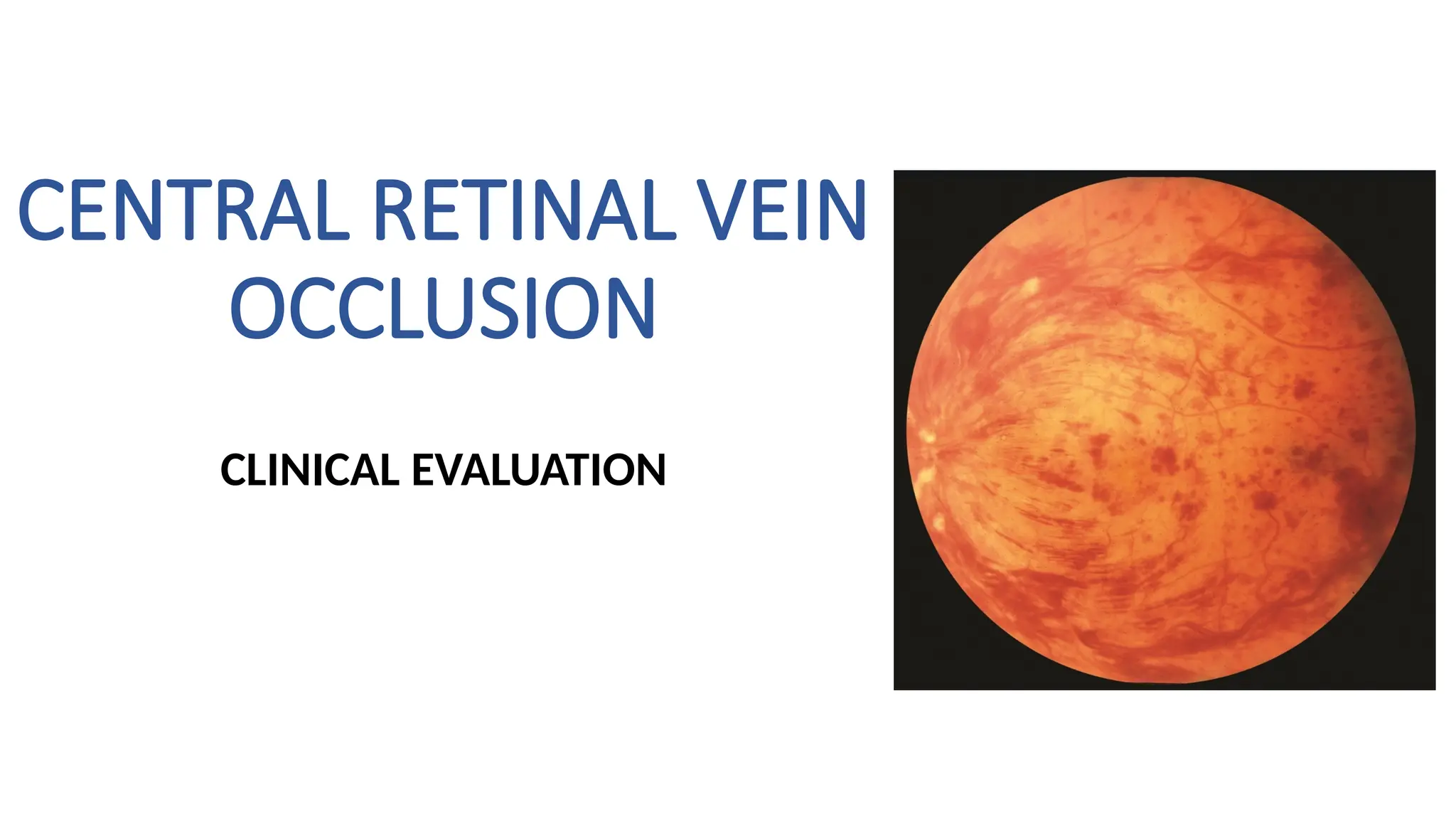 CRVO clinical evaluation, diagnosis.pptx