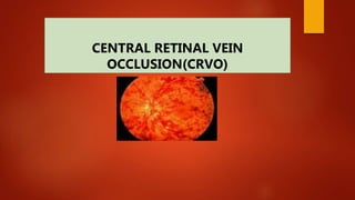 CRVO | PPTX | Eye and Vision Conditions | Diseases and Conditions