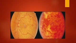 CRVO | PPTX | Eye and Vision Conditions | Diseases and Conditions