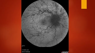 CRVO | PPTX | Eye and Vision Conditions | Diseases and Conditions