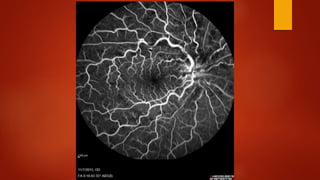 CRVO | PPTX | Eye and Vision Conditions | Diseases and Conditions