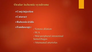 CRVO | PPTX | Eye and Vision Conditions | Diseases and Conditions