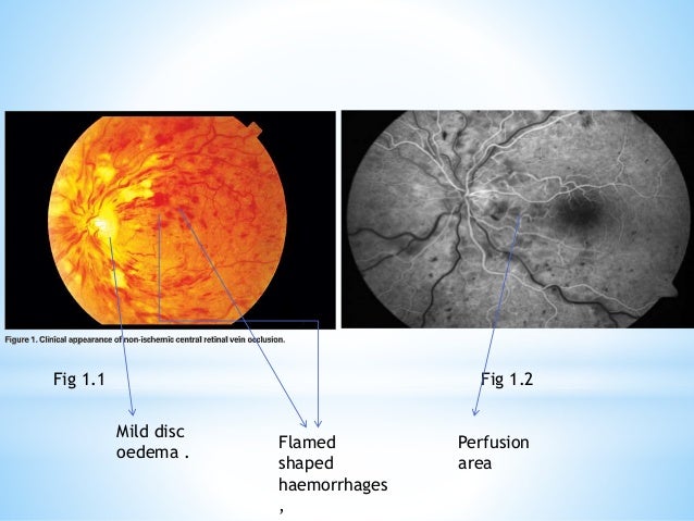 Crvo vs brvo by Dr.kausar ali