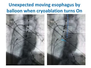 Atrial Fibrillation Cryoablation Esophagus | PPTX | Surgery | Medical ...