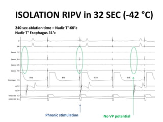 Atrial Fibrillation Cryoablation Esophagus | PPTX | Surgery | Medical ...