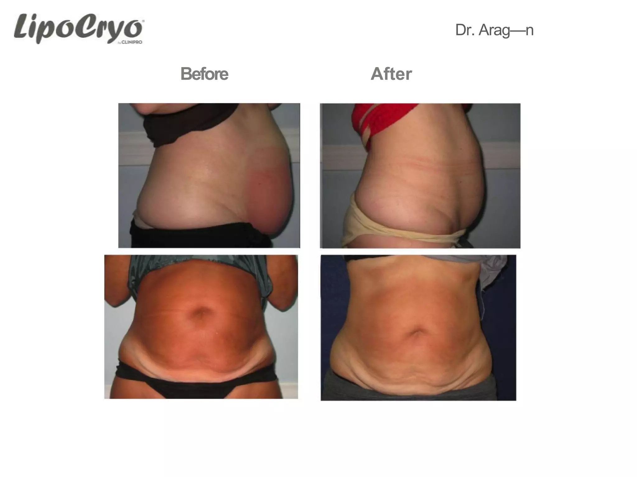 Cryolipolyse lipo cryo voor_na | PPTX