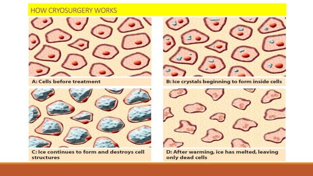 Cryosurgery | PPTX | First Aid | Injuries