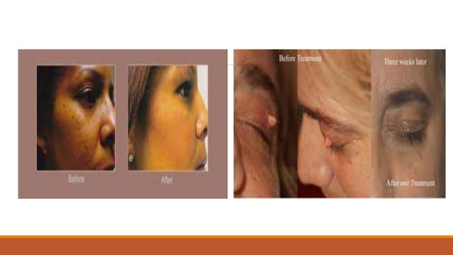Cryosurgery | PPTX | First Aid | Injuries