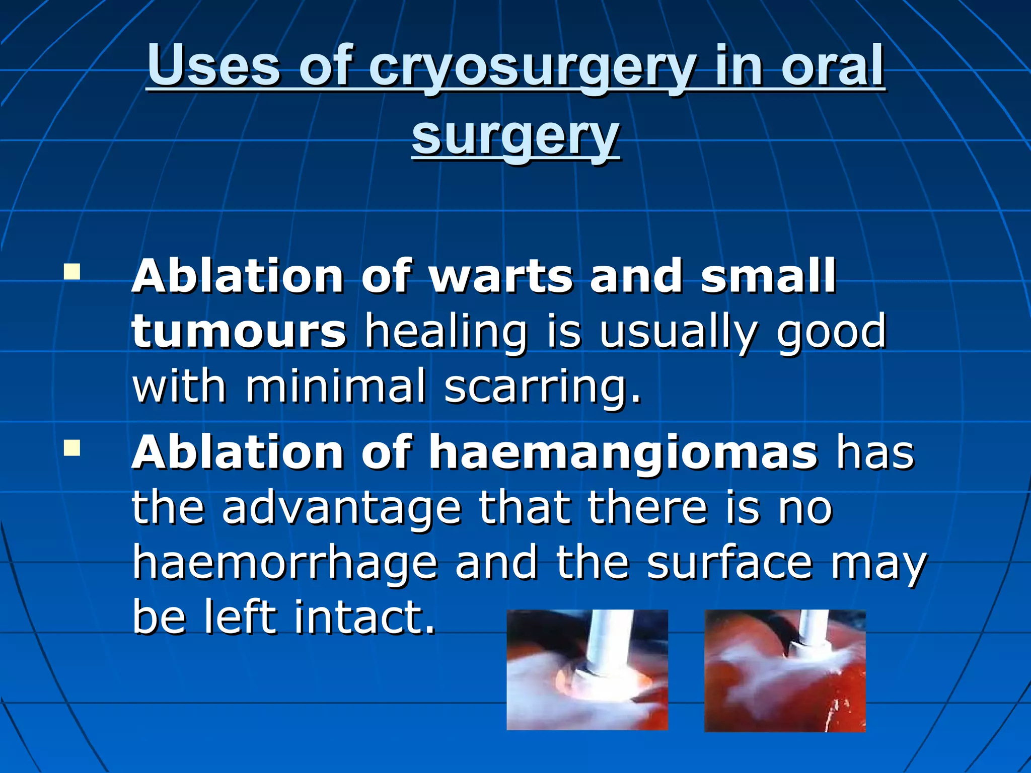 Cryosurgery | PPT
