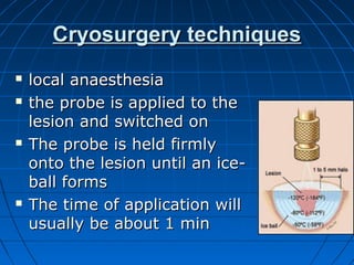 Cryosurgery | PPT