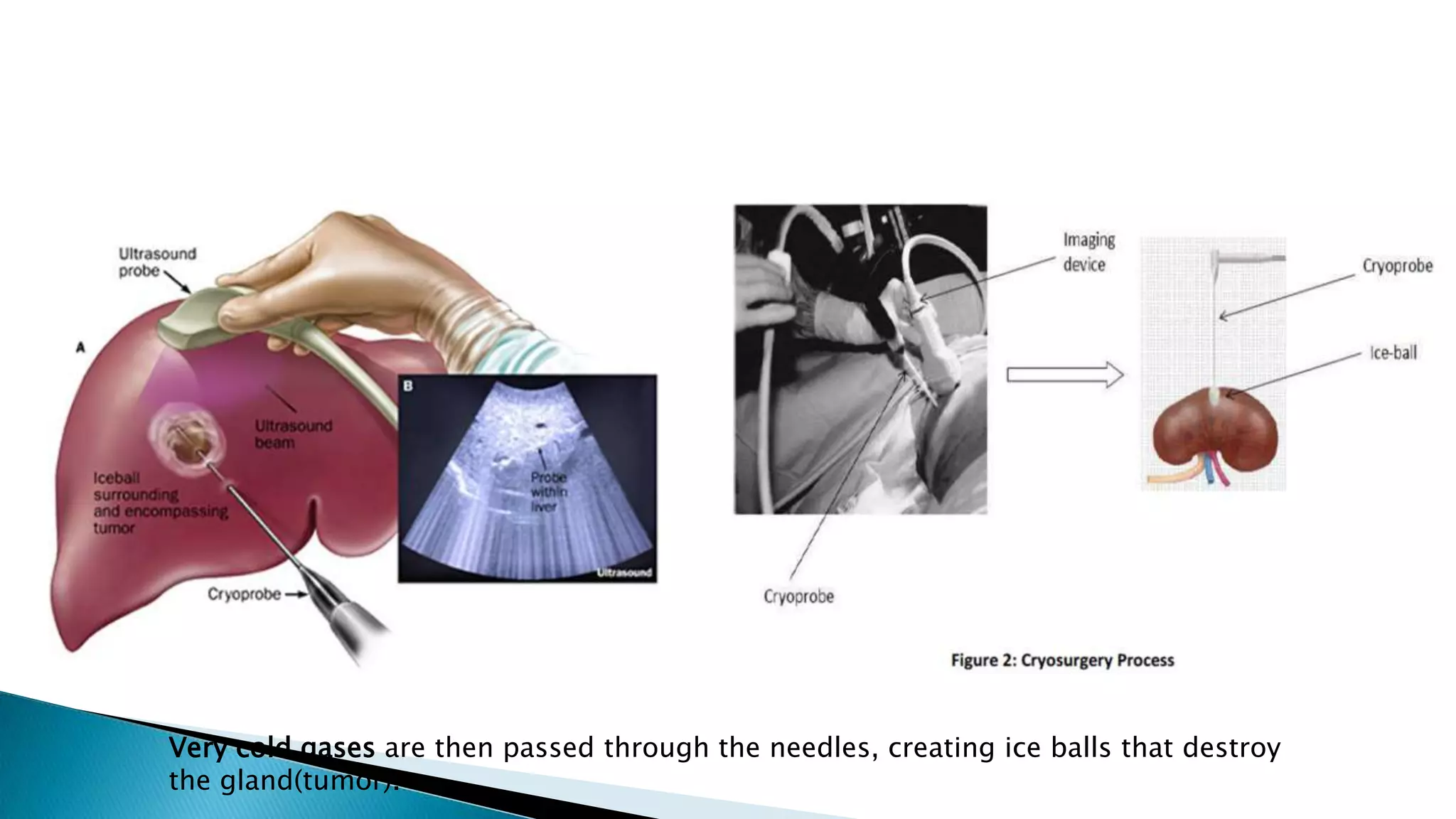Cryosurgery | PPTX