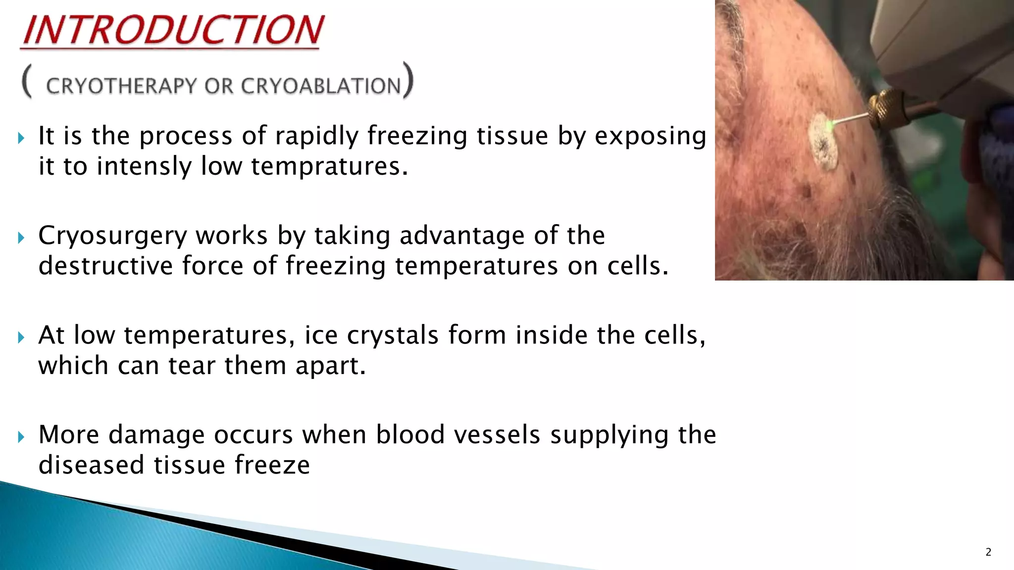Cryosurgery | PPTX