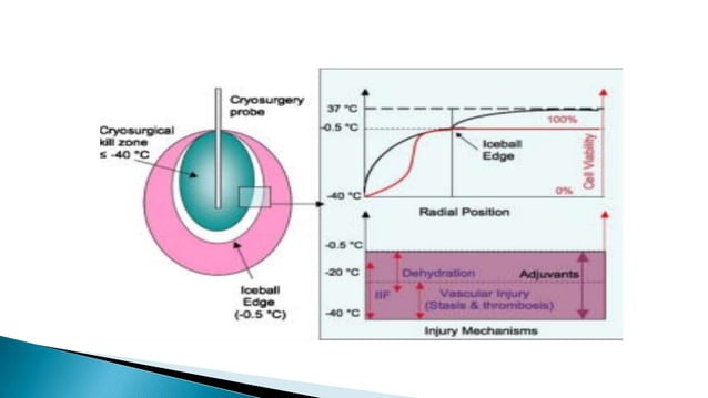 Cryosurgery | PPTX