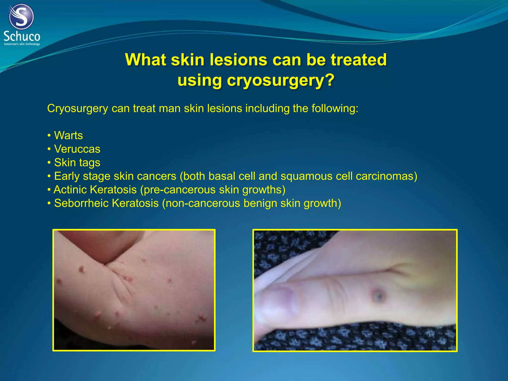 Cryosurgery | PDF