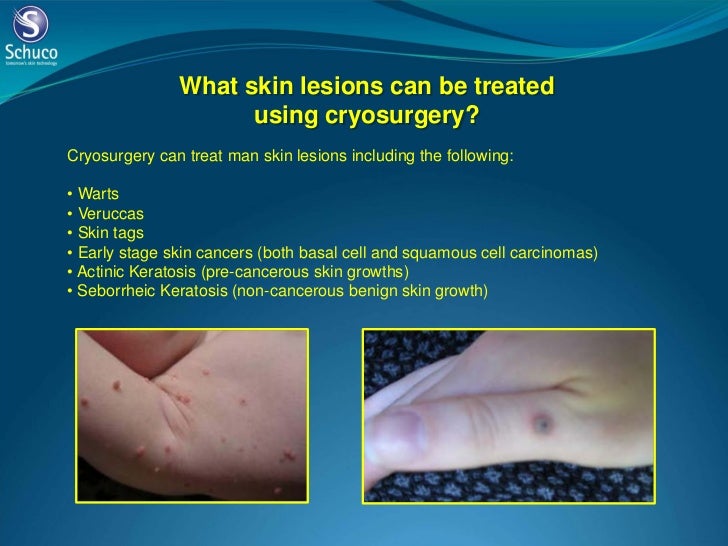 Cryosurgery