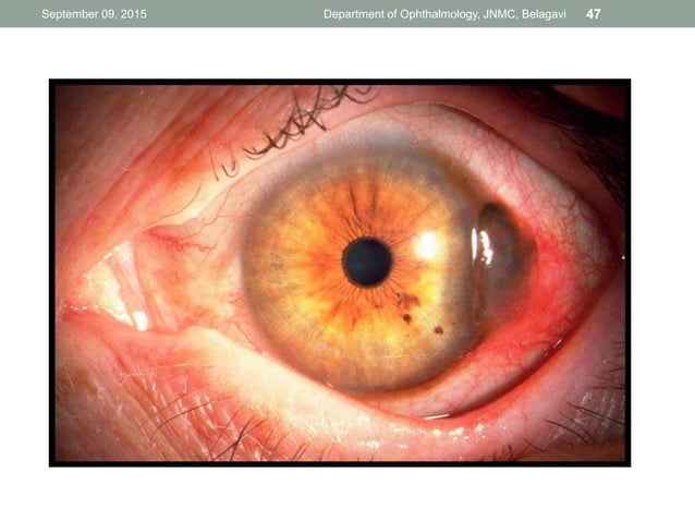 Cryotherapy in Ophthalmology | PPTX