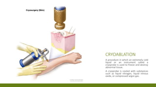 Cryotherapy | PPT