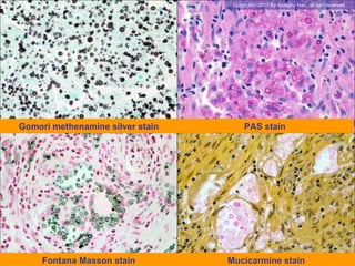 Cryptococcosis | PPS