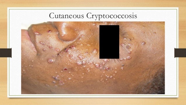 Cryptococcosis