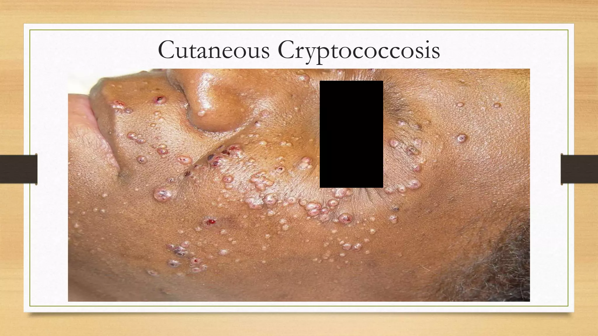 Cryptococcal Meningitis | PPTX