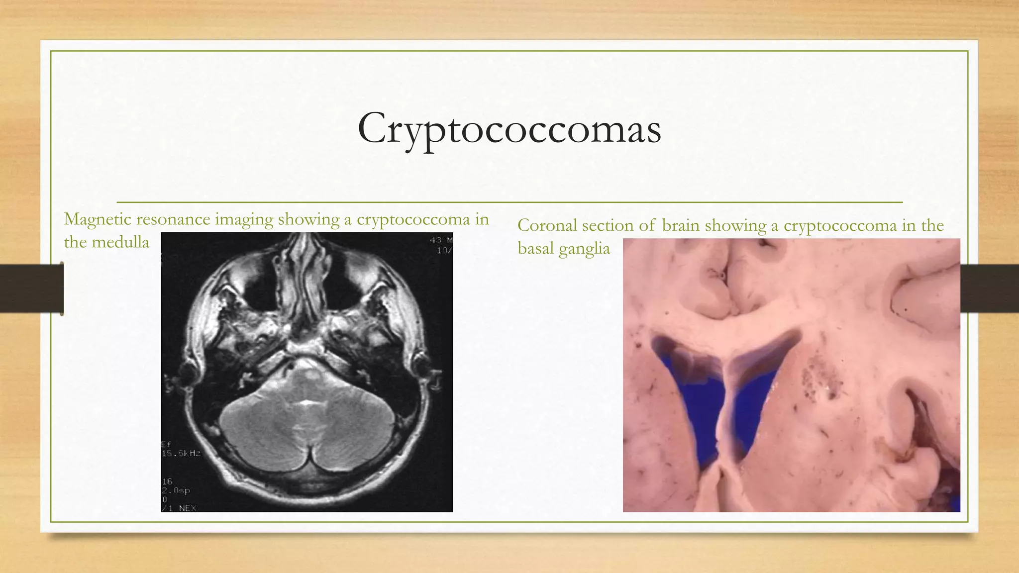 Cryptococcal Meningitis | PPTX