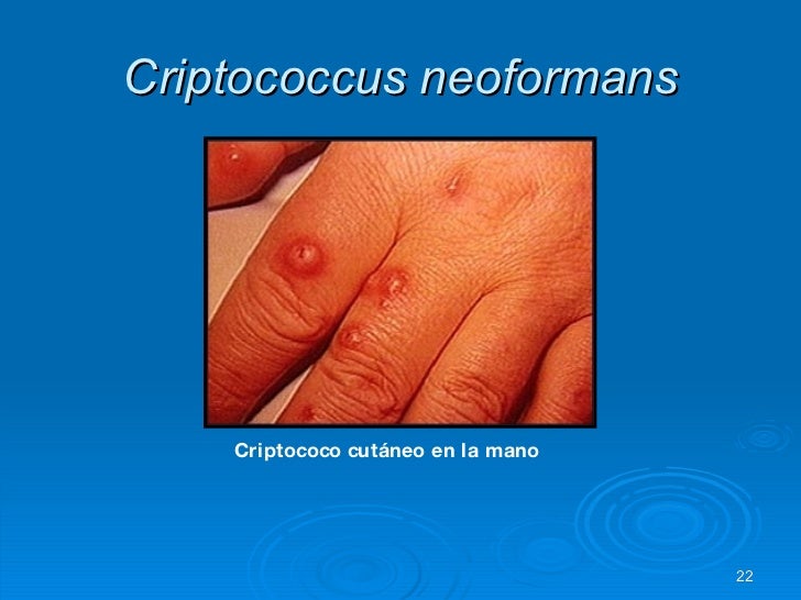 Cryptococcus Neoformans
