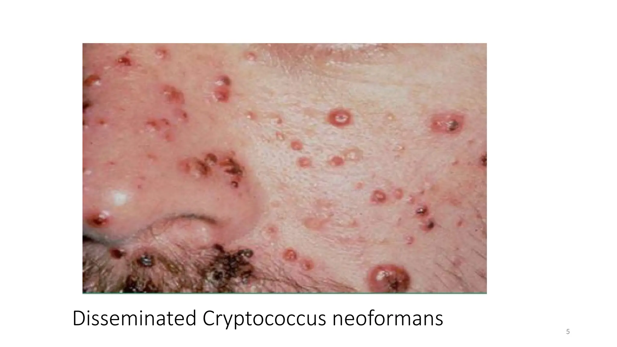 Cryptococcus neoformans (1).............pptx