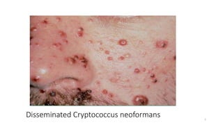 Cryptococcus neoformans (1).............pptx
