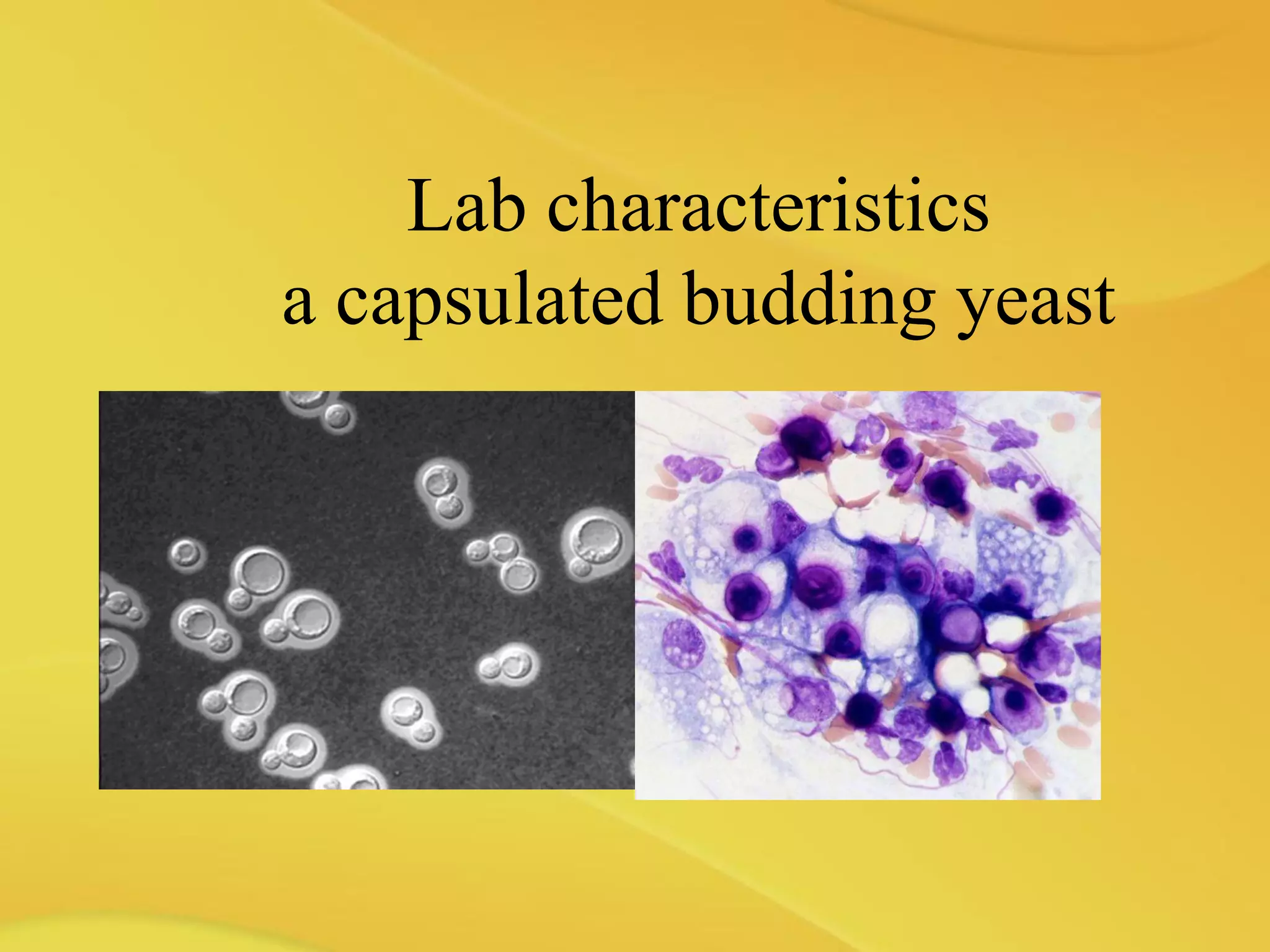 Cryptococcus neoformans infection.pdf