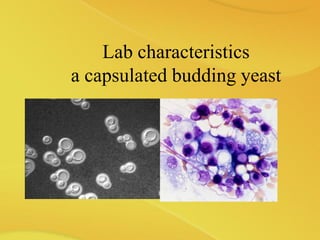 Cryptococcus neoformans infection.pdf