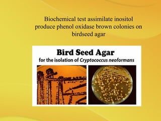 Cryptococcus neoformans infection.pdf