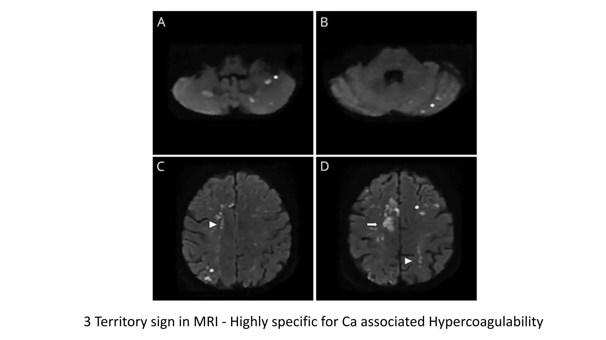 CRYPTOGENIC STROKE.pptx