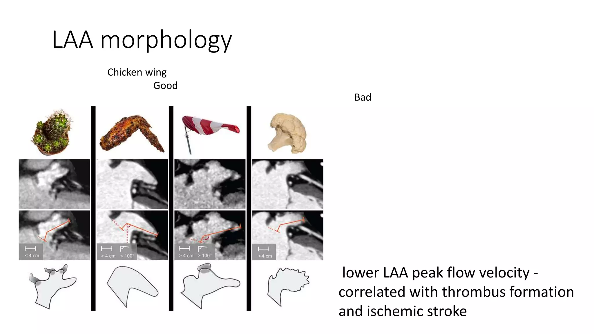CRYPTOGENIC STROKE.pptx