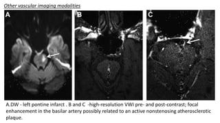 CRYPTOGENIC STROKE.pptx