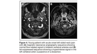 CRYPTOGENIC STROKE.pptx