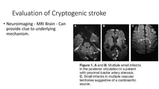 CRYPTOGENIC STROKE.pptx