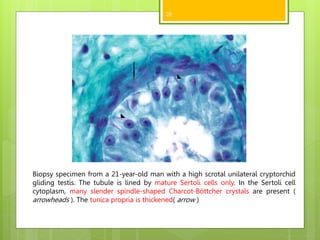 Undescended Testis- Cryptorchidism | PPTX