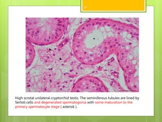 Cryptorchidism Histology