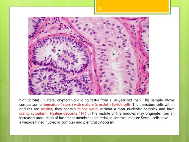 Undescended Testis Cryptorchidism