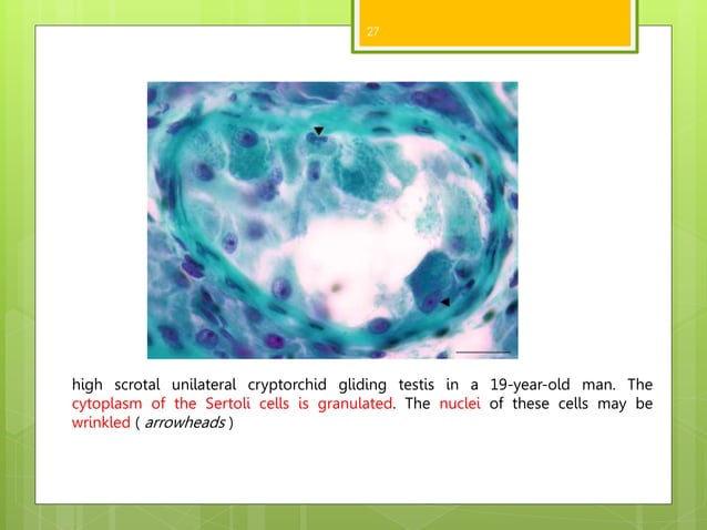 Undescended Testis Cryptorchidism
