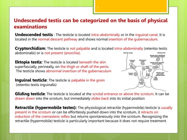Undescended Testis Cryptorchidism