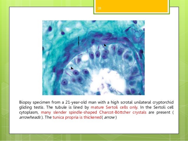 Undescended Testis Cryptorchidism