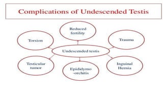 Cryptorchidism | PPTX