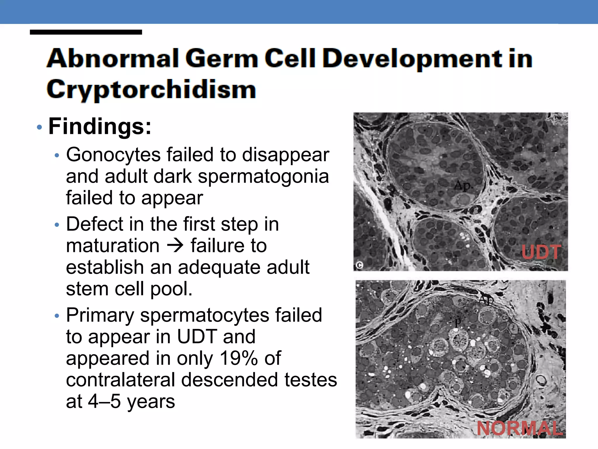 Cryptorchidism (Undescended Testes) | PPTX